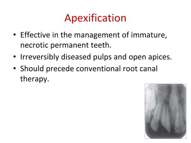 Apexification | PPTX