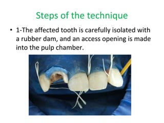 Apexification | PPTX