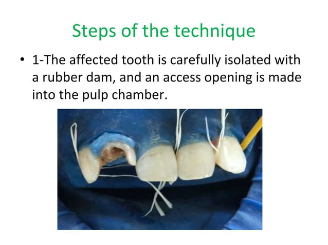 Apexification | PPTX