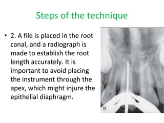 Apexification | PPTX
