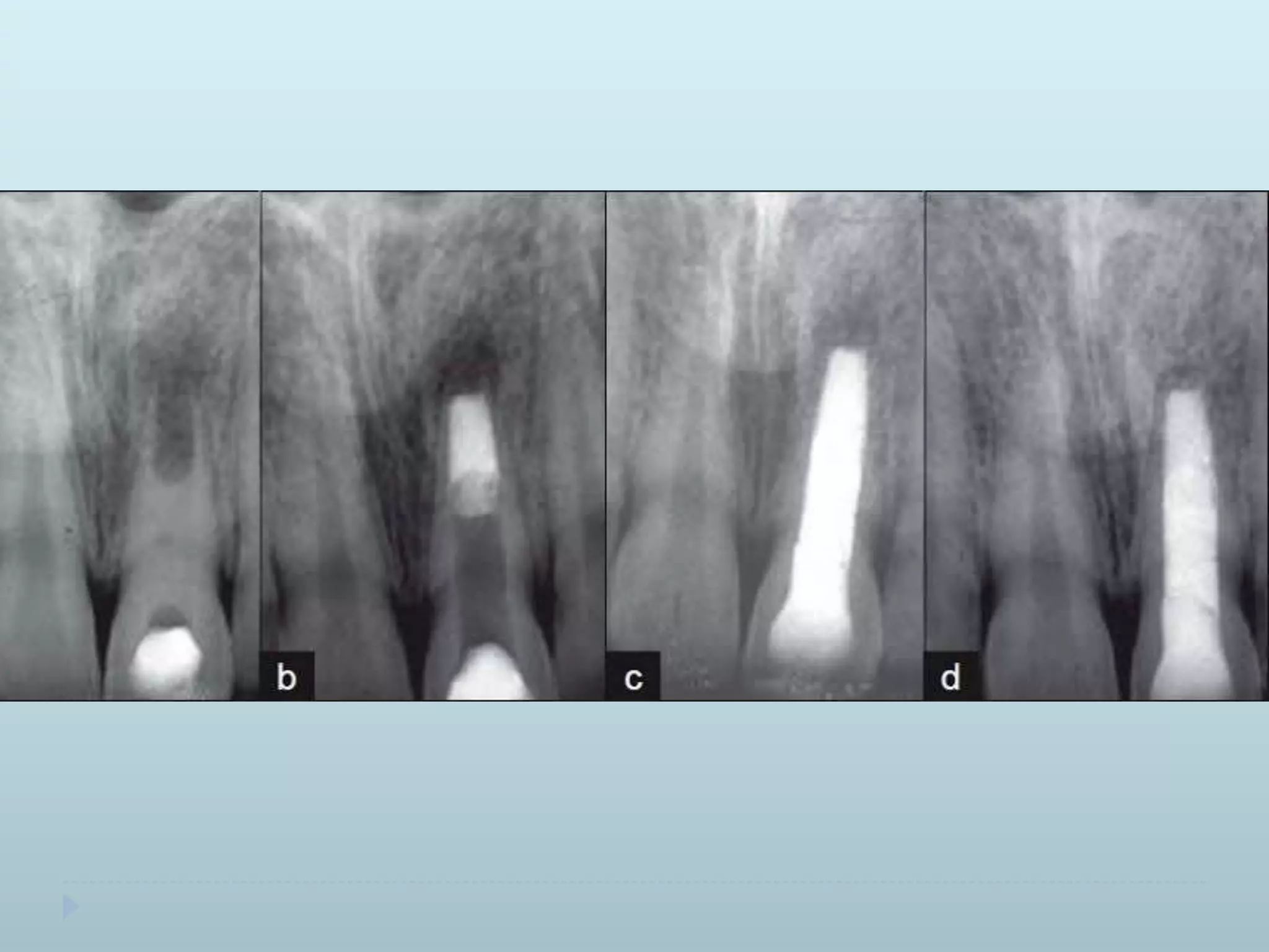 Apexification | PPTX