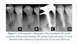 Apexification in endodontics PowerPoint presentation | PPTX