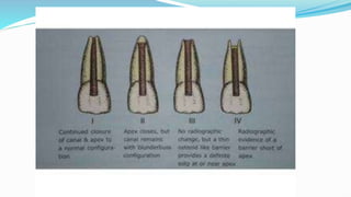 Apexification in endodontics PowerPoint presentation | PPTX