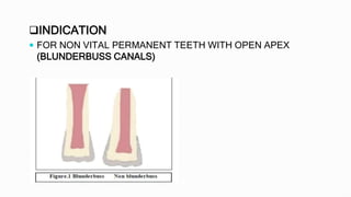 Apexification in endodontics PowerPoint presentation | PPTX