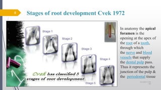 Apexification and apexogenesis | PPTX