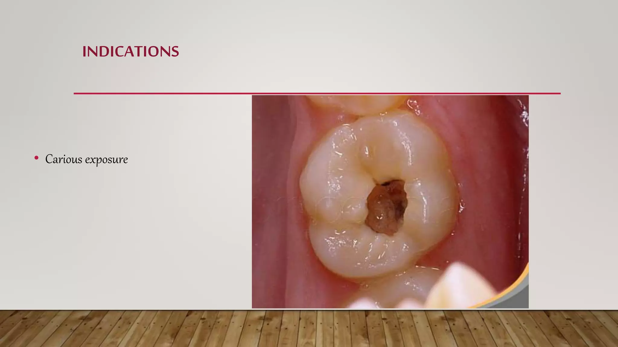 Apexification and Apexogenesis | PPTX