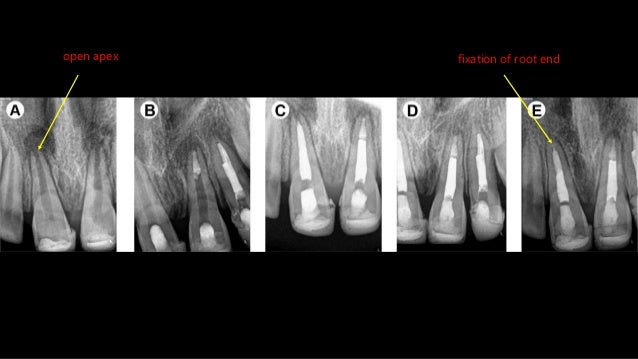 Apexification and Apexogenesis