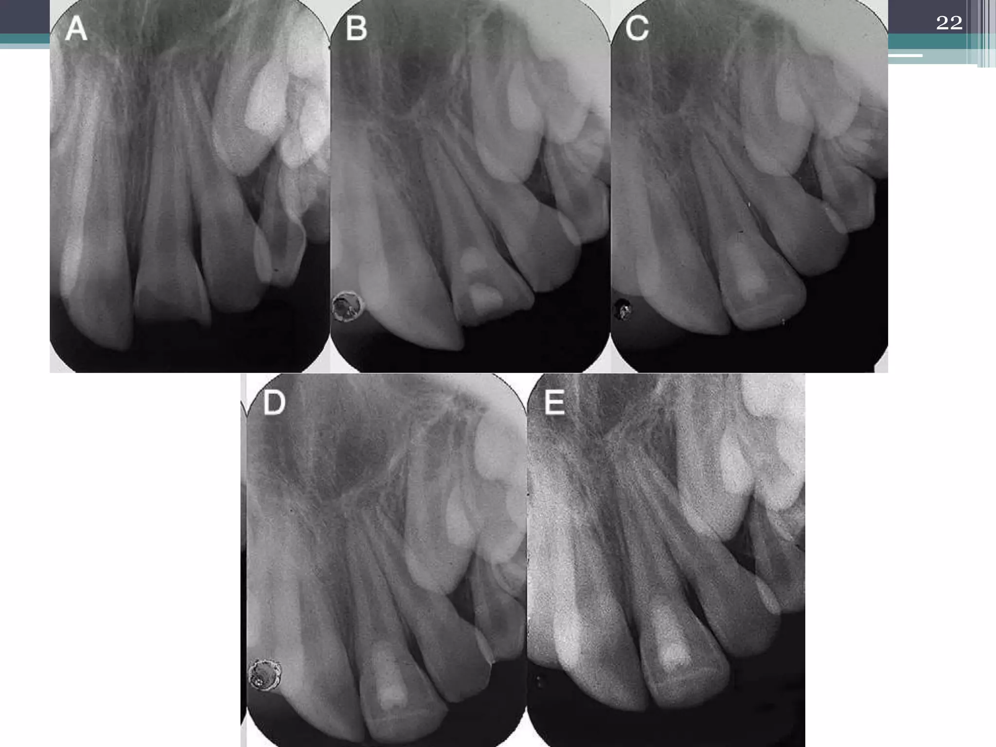 Apexification & apexogenesis | PPTX