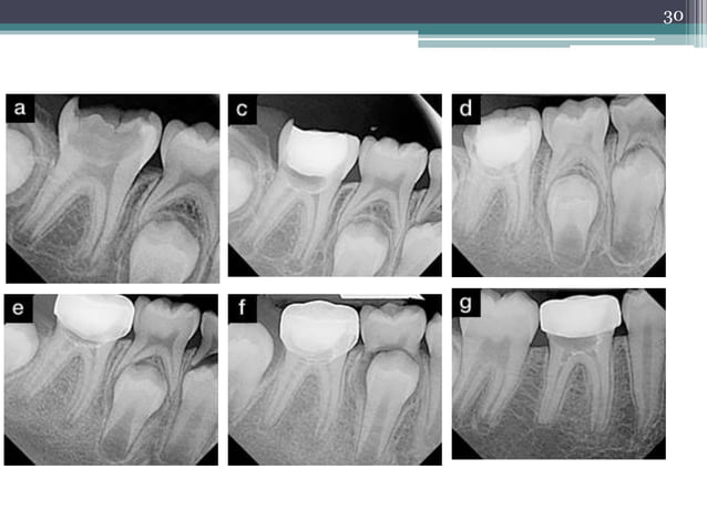 Apexification & apexogenesis | PPTX | Dental Health | Diseases and ...