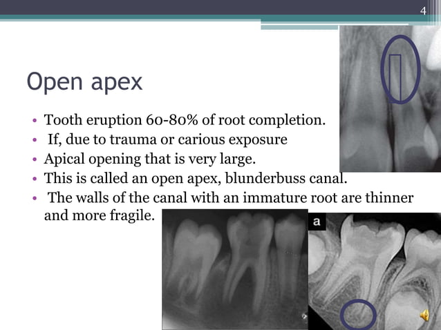 Apexification & apexogenesis | PPTX | Dental Health | Diseases and ...