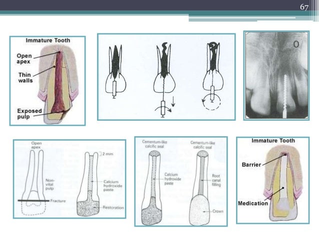 Apexification & apexogenesis