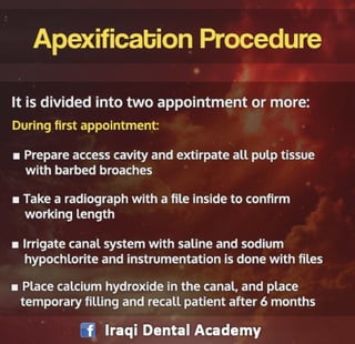 Apexification Procedure - Pediatric Dental Lecture | PDF
