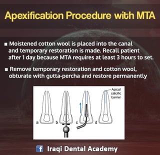 Apexification Procedure - Pediatric Dental Lecture | PDF
