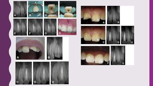 Apexogenesis and apexification | PPTX | Dental Health | Diseases and ...