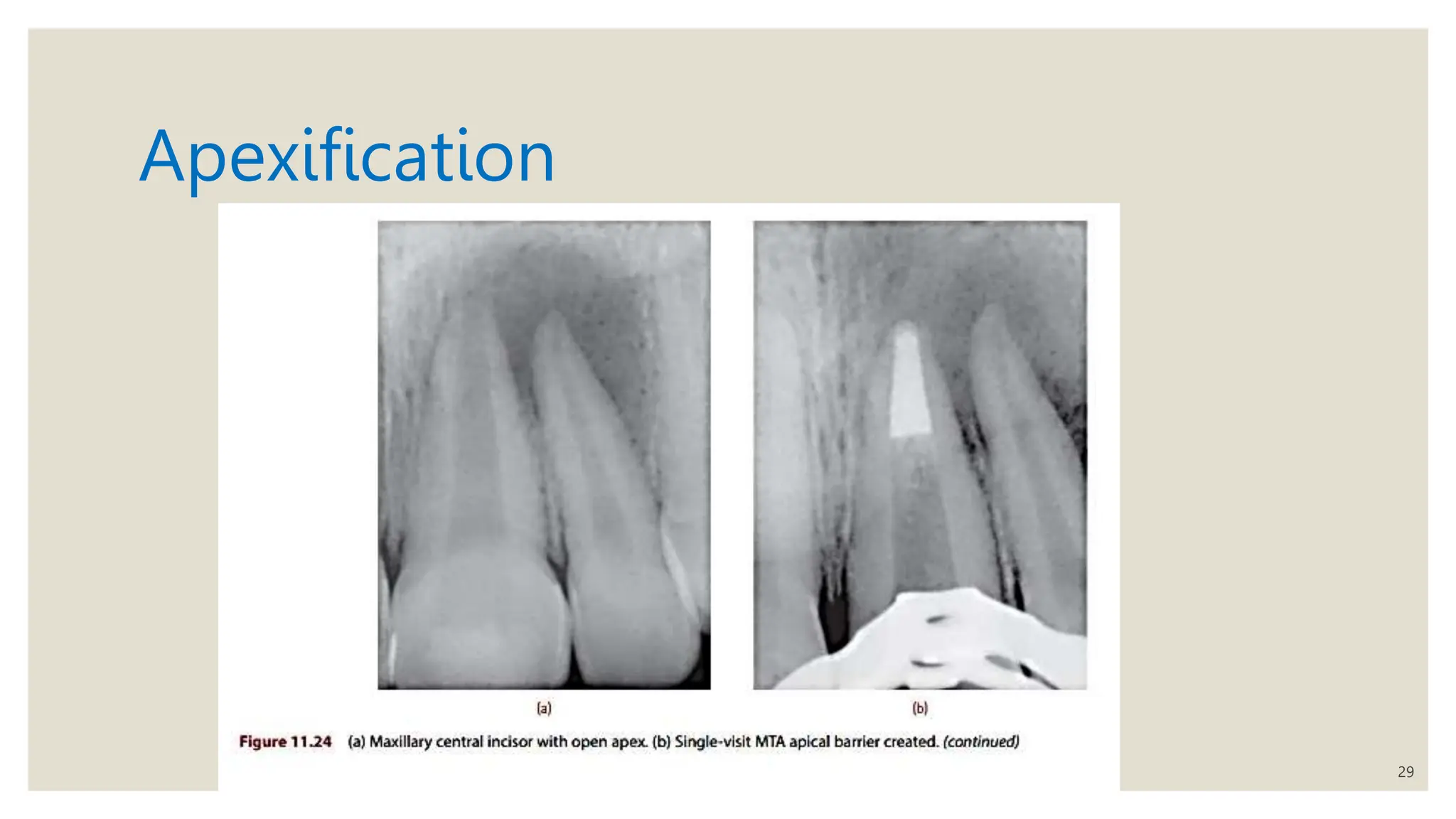 Apexogenesis and apexification.pptx endodontics final year | PPTX