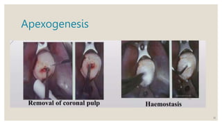 Apexogenesis and apexification.pptx endodontics final year | PPTX