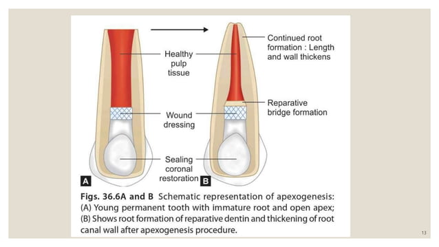 Apexogenesis and apexification.pptx endodontics final year | PPTX