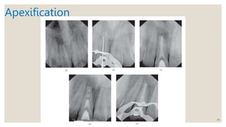 Apexogenesis and apexification.pptx endodontics final year | PPTX