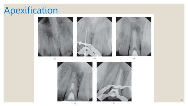 Apexogenesis and apexification.pptx endodontics final year | PPTX