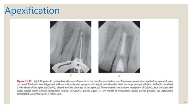 Apexogenesis and apexification.pptx endodontics final year | PPTX