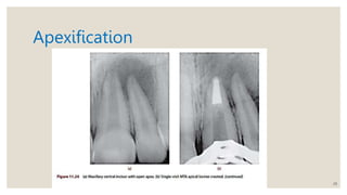 Apexogenesis and apexification.pptx endodontics final year | PPTX