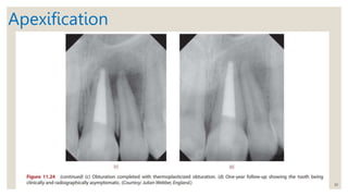 Apexogenesis and apexification.pptx endodontics final year | PPTX