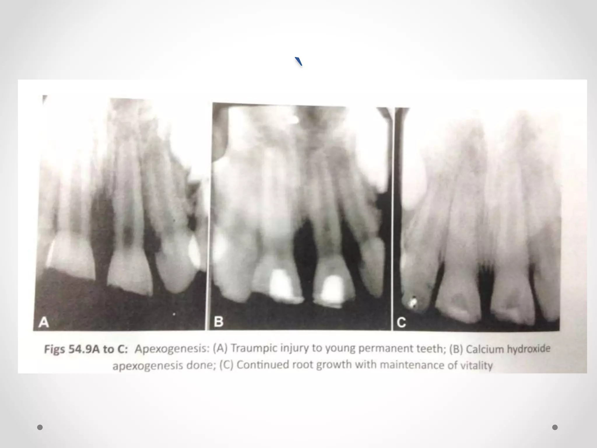 Apexogenesis & apexification in pediatric dentistry | PPTX