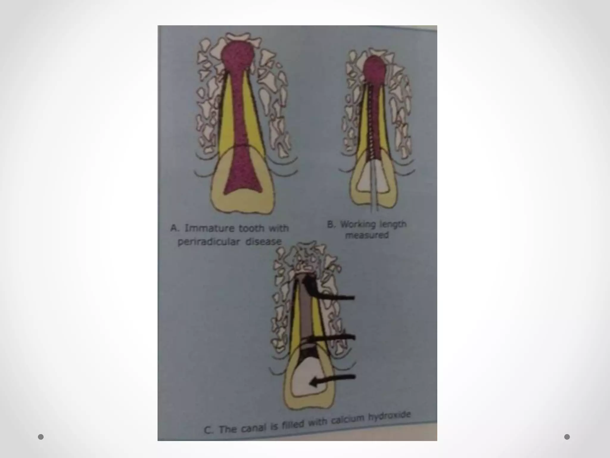 Apexogenesis & apexification in pediatric dentistry | PPTX
