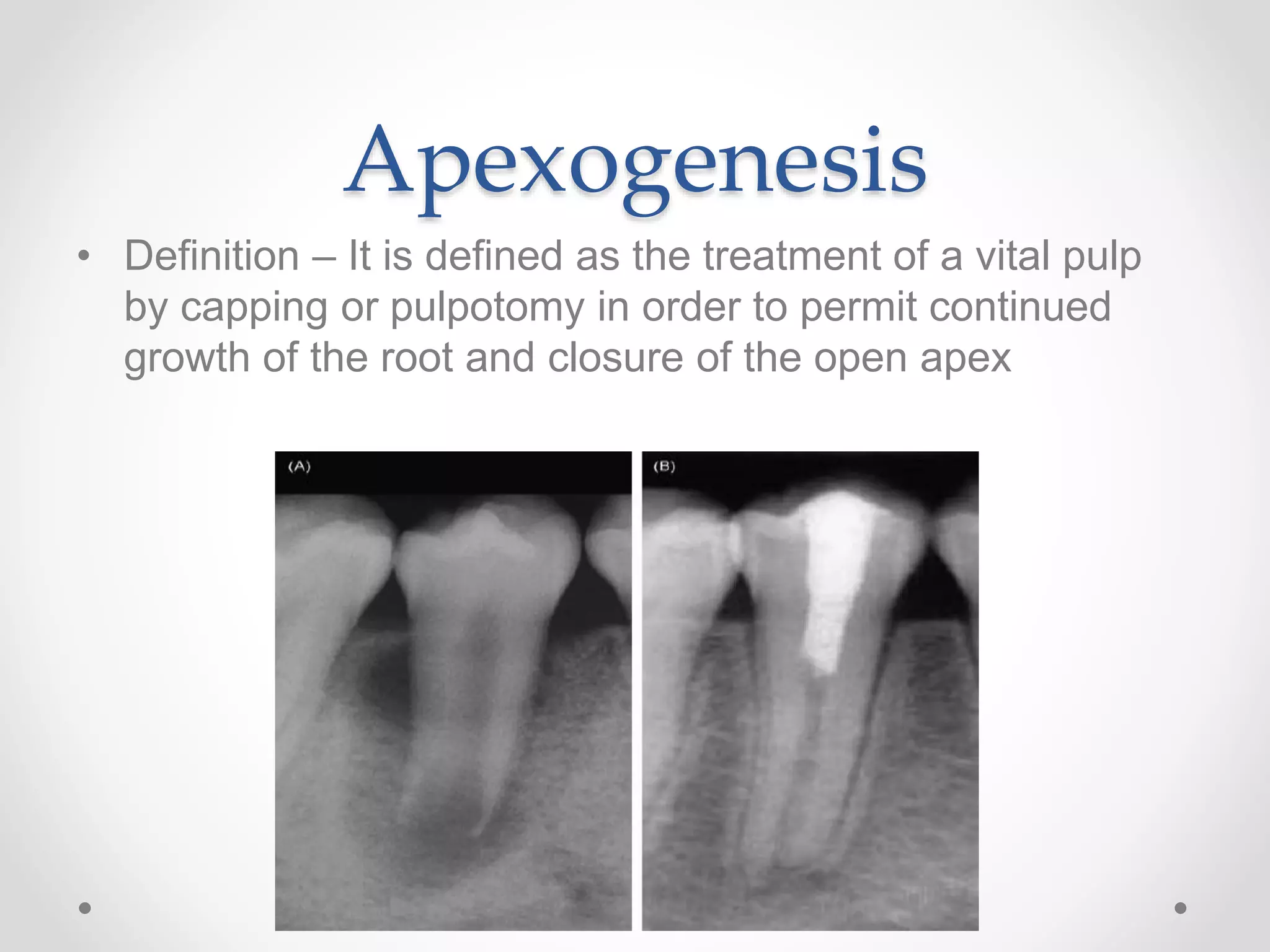 Apexogenesis & apexification in pediatric dentistry | PPTX
