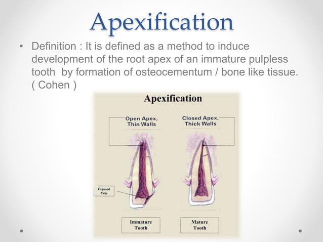 Apexogenesis & apexification in pediatric dentistry | PPTX | Dental ...