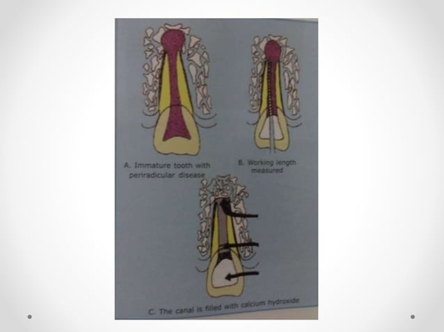 Apexogenesis & apexification in pediatric dentistry | PPTX | Dental ...
