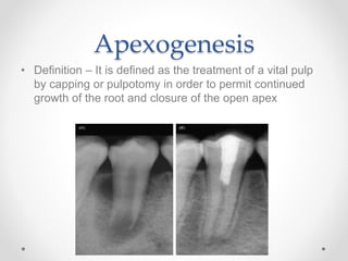 Apexogenesis & apexification in pediatric dentistry | PPTX