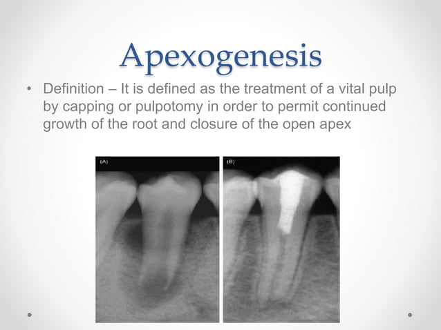 Apexogenesis & apexification in pediatric dentistry | PPTX | Dental ...