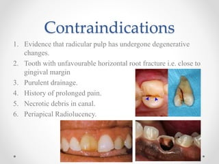 Apexogenesis & apexification in pediatric dentistry | PPT