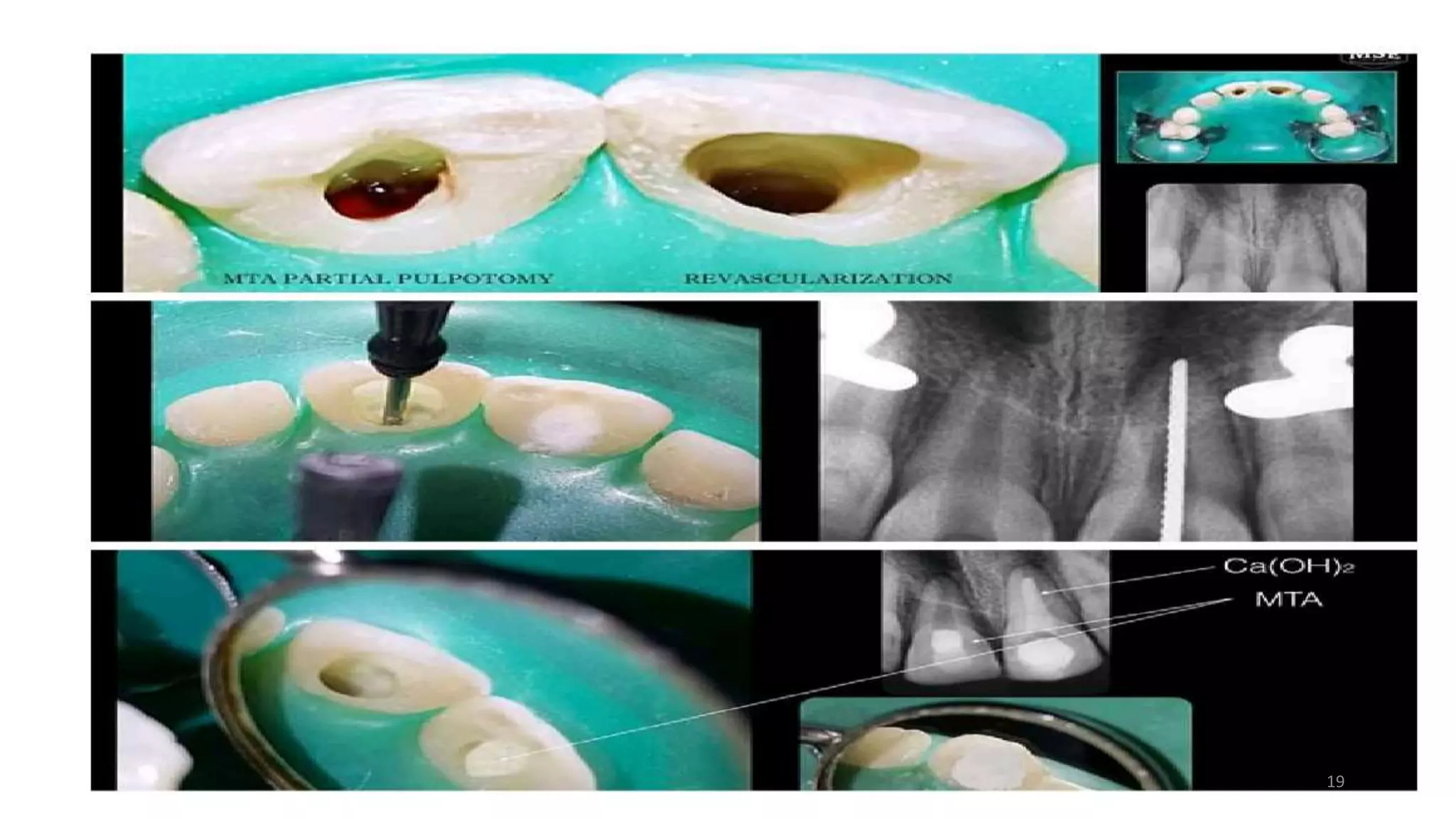 Apexogenesis apexification and revascularization | PPTX