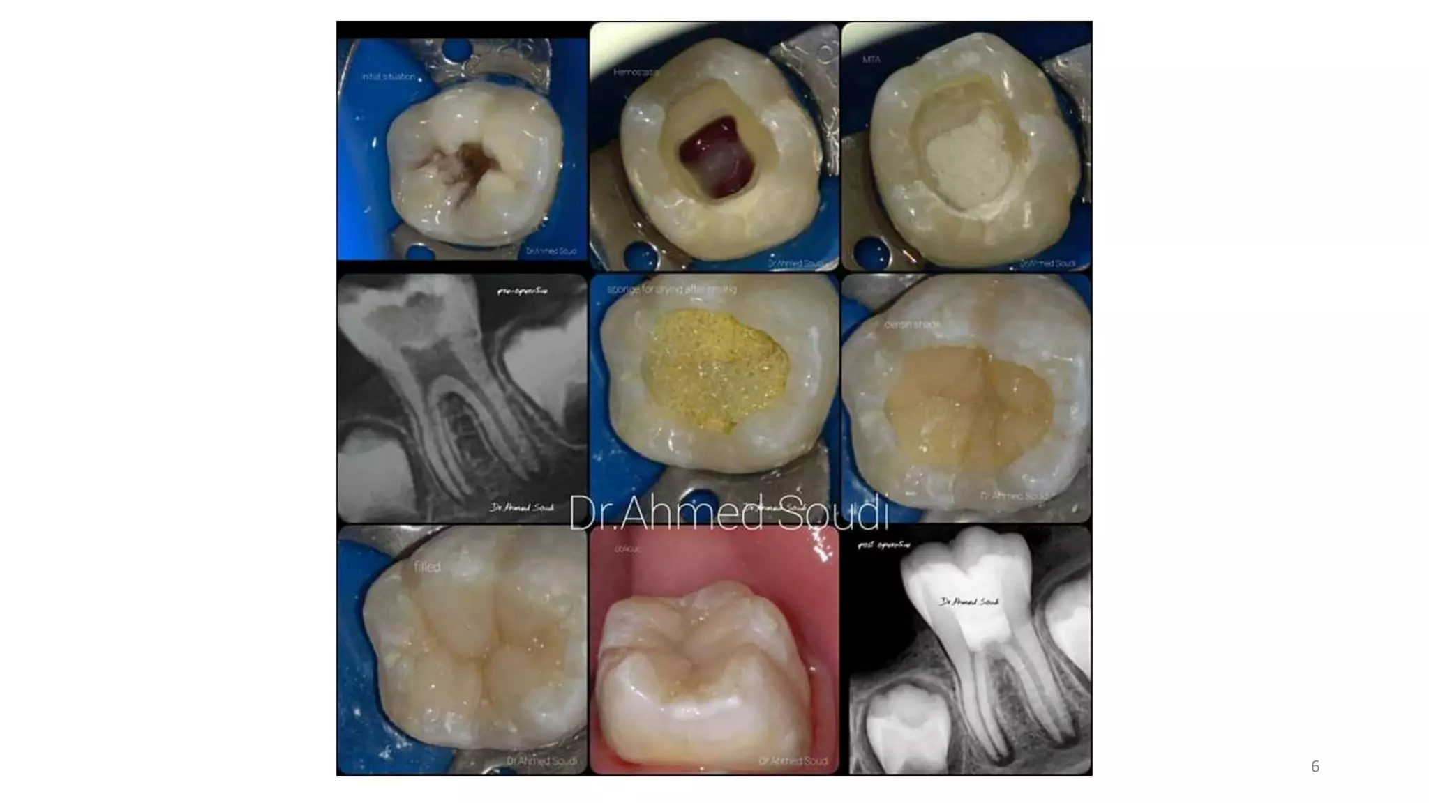 Apexogenesis apexification and revascularization | PPTX