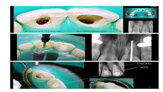 Apexogenesis apexification and revascularization | PPTX