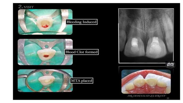Apexogenesis apexification and revascularization
