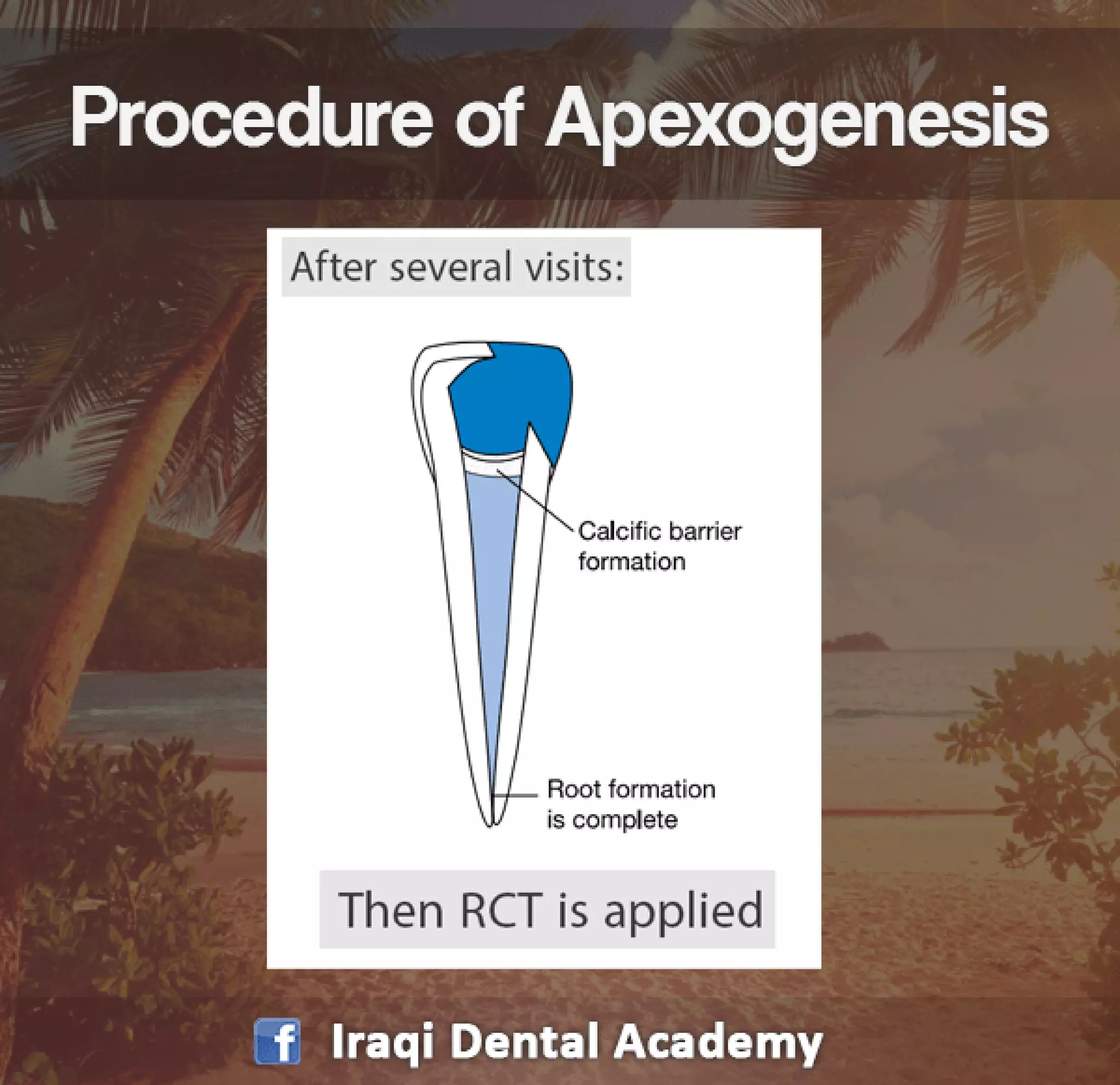 Apexogenesis Procedure - A Pediatric Lecture | PDF