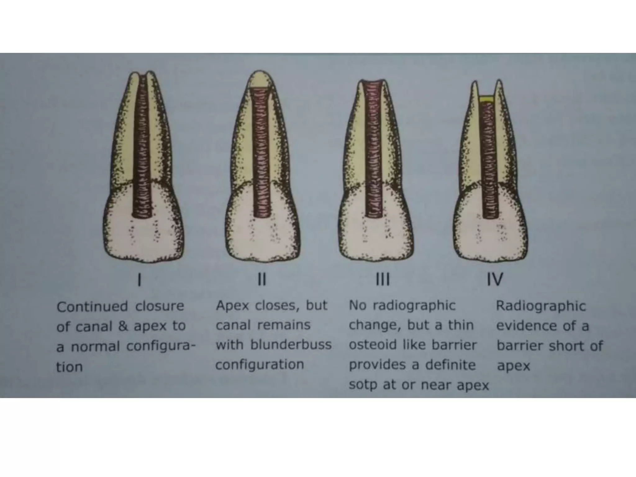 Apexogenesis and Apexification - pediatric dentistry | PPTX