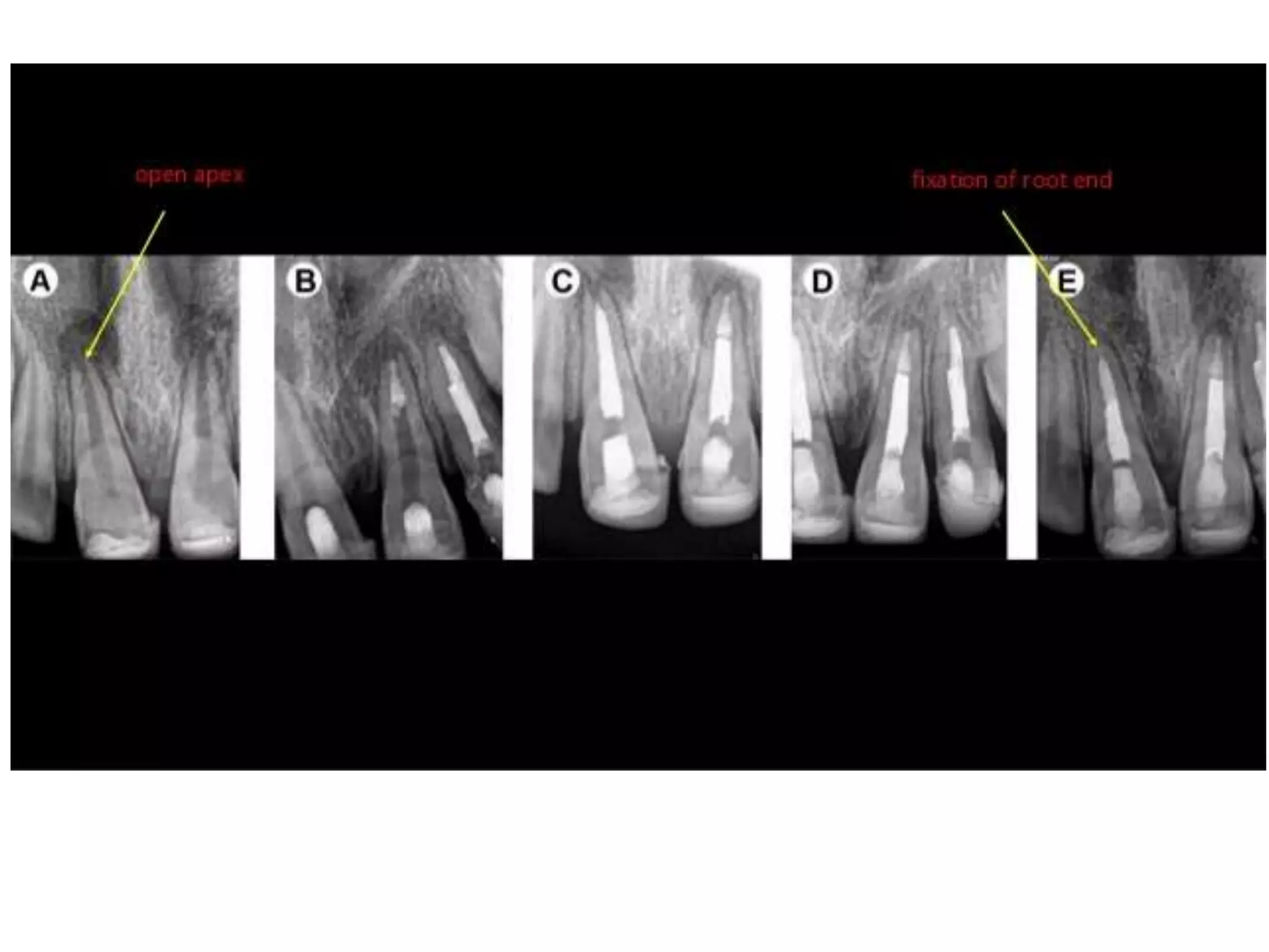 Apexogenesis and Apexification - pediatric dentistry | PPTX