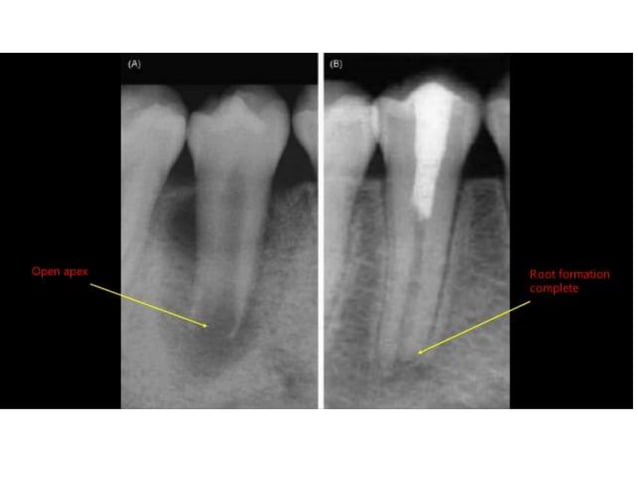 Apexogenesis and Apexification - pediatric dentistry | PPTX | Dental ...