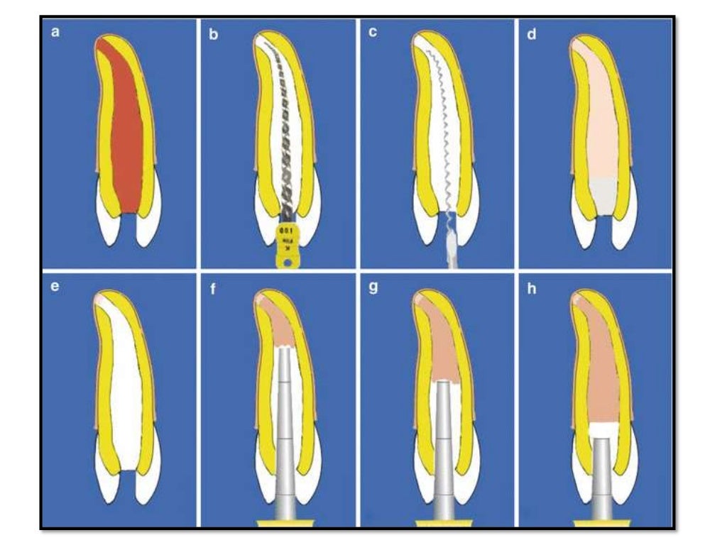 Apexogenesis and Apexification - pediatric dentistry