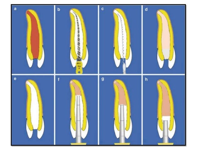 Apexogenesis and Apexification - pediatric dentistry