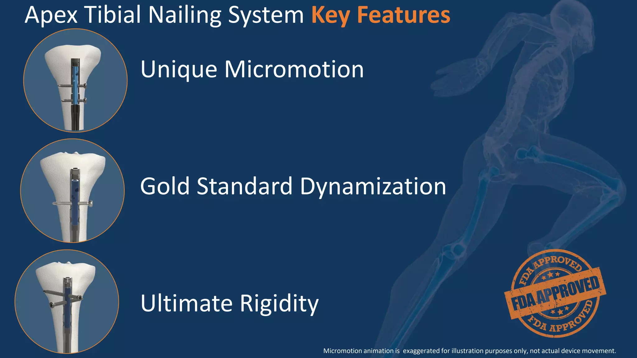 OrthoXel Apex Tibial Nailing System Summary | PDF