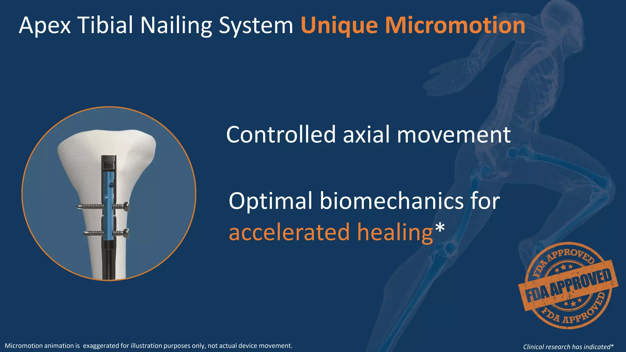 OrthoXel Apex Tibial Nailing System Summary | PDF