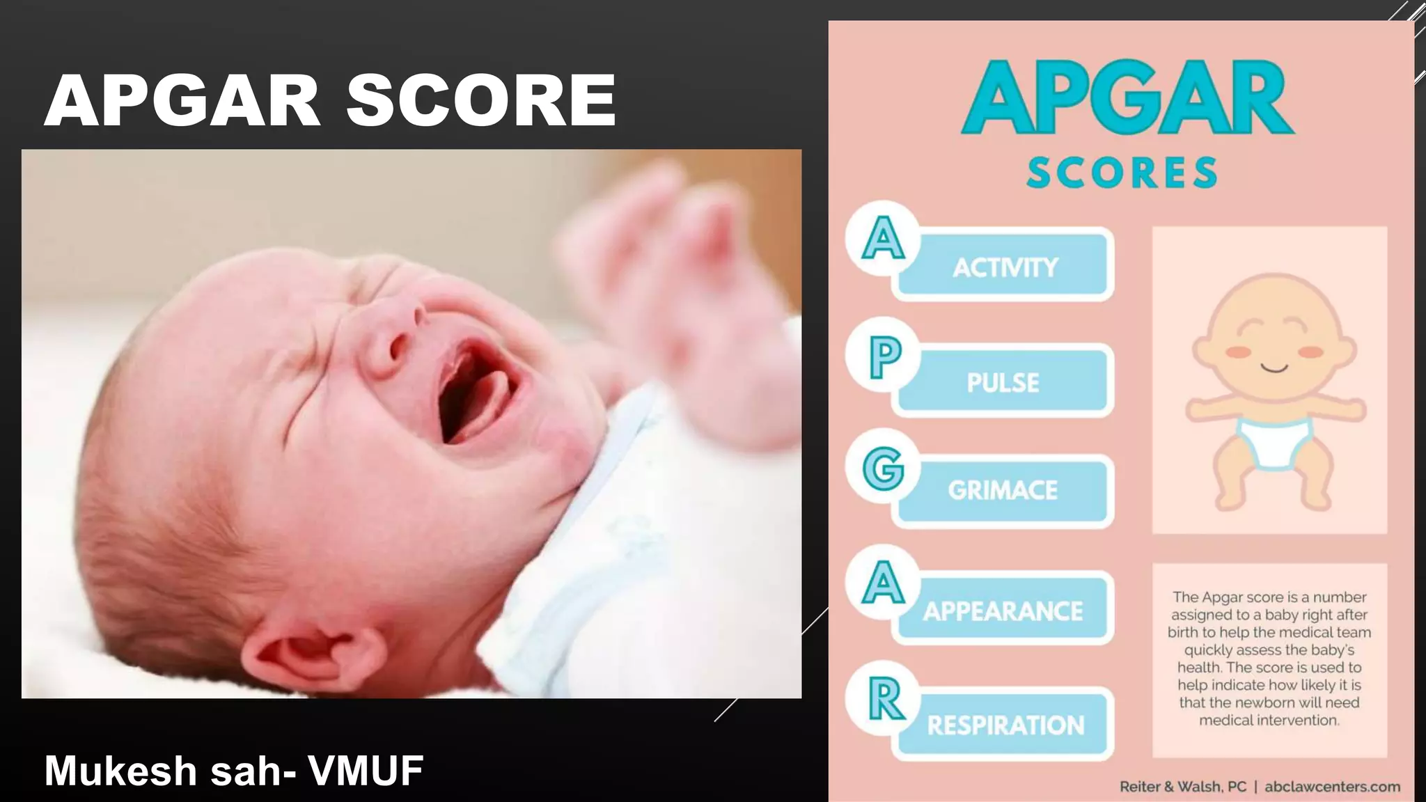 Apgar score | PPTX