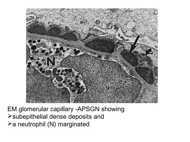 NEPHRITIC SYNDROME / APSGN IN CHILDREN | PPT