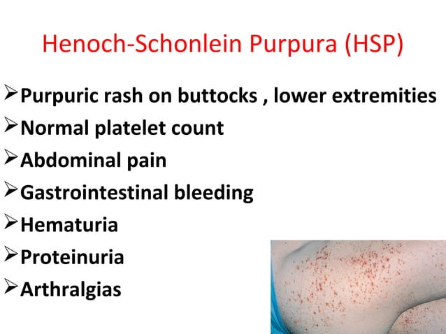 NEPHRITIC SYNDROME / APSGN IN CHILDREN | PPT