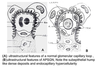 NEPHRITIC SYNDROME / APSGN IN CHILDREN | PPT